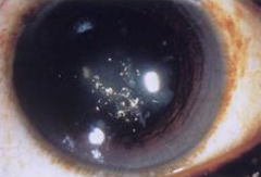 Medicine Decoded: Cataracts-Few interesting types